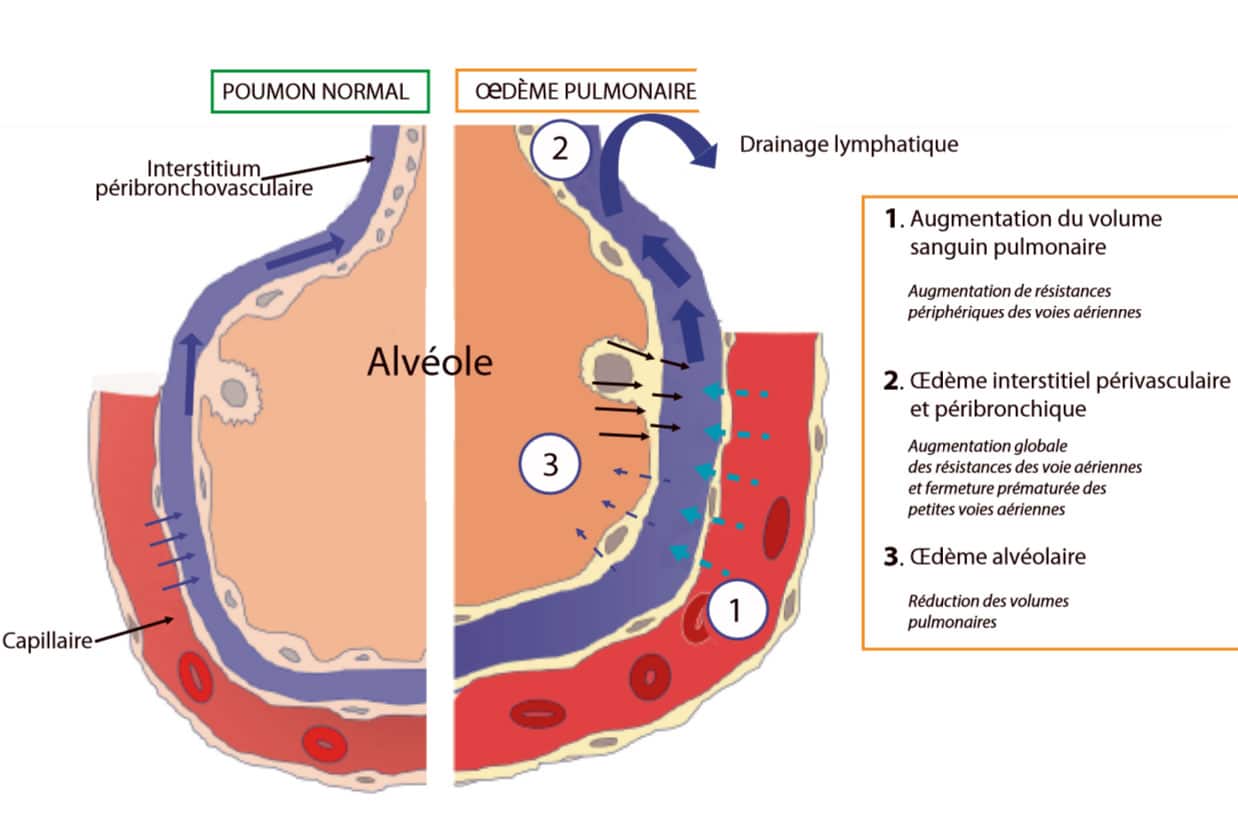 L’œdème pulmonaire d’immersion. - CSVN Narcosis